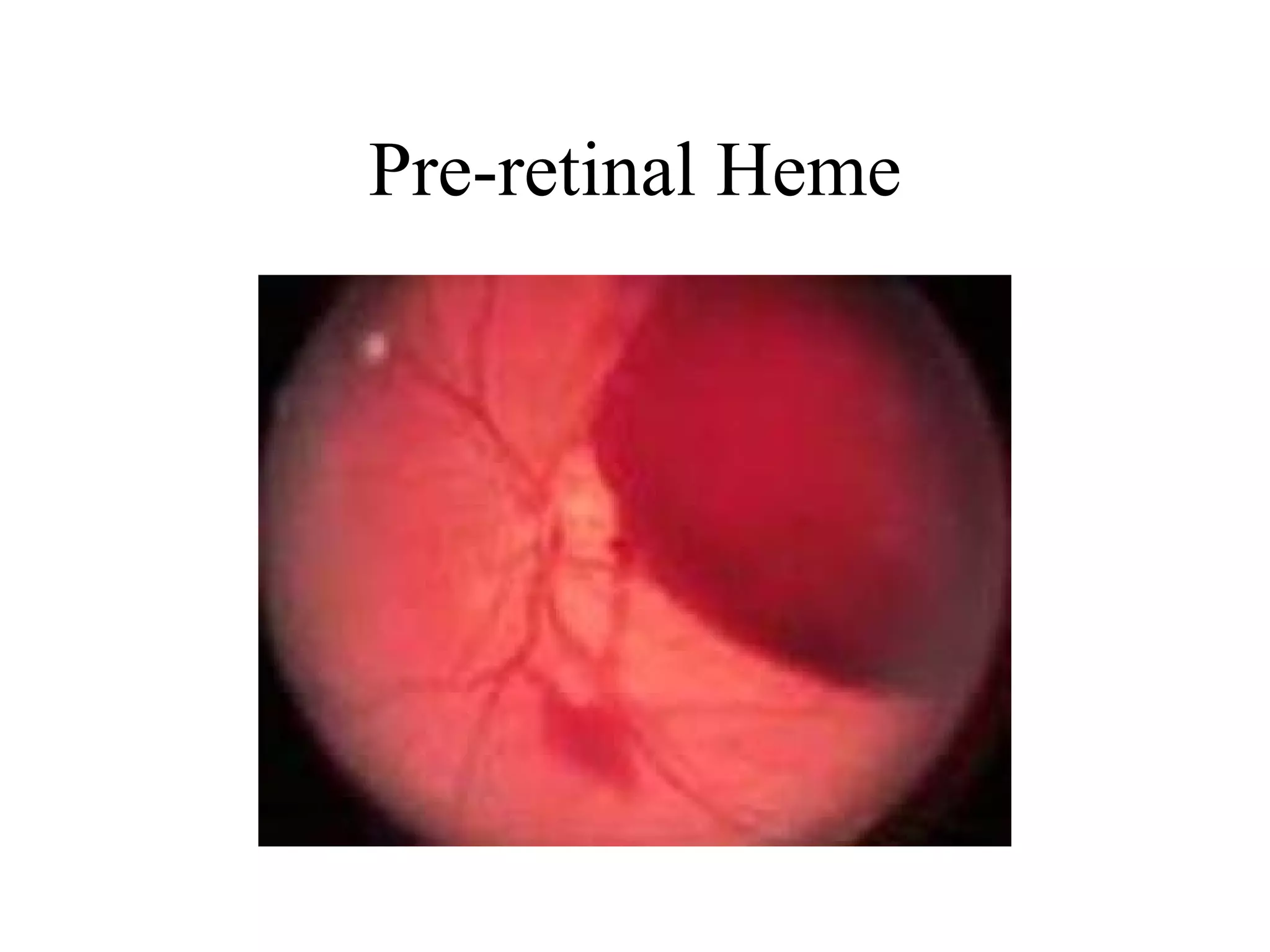 Traumatic Hyphema | PPT
