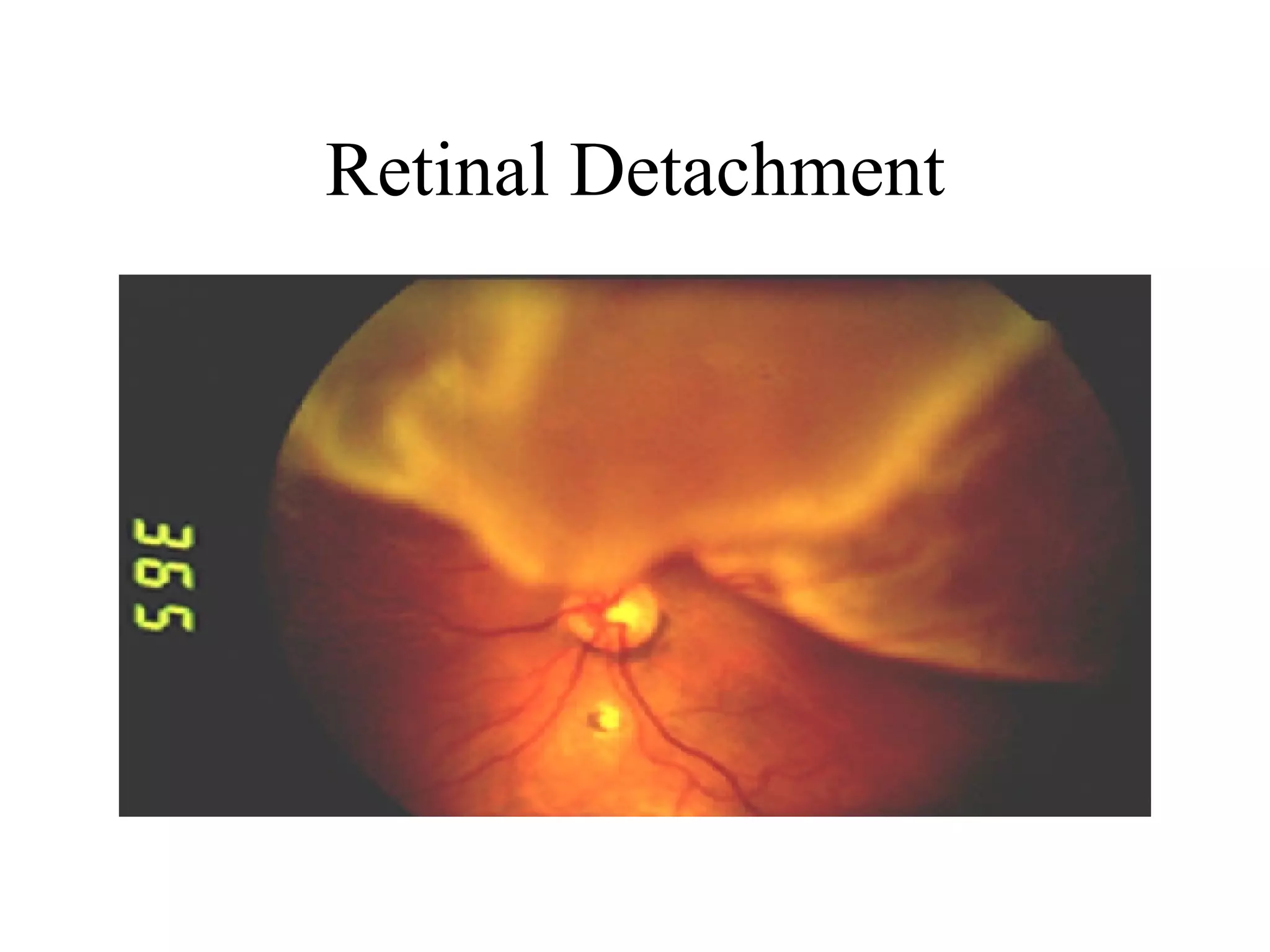 Traumatic Hyphema | PPT