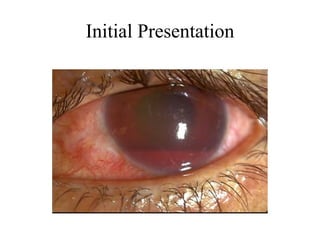 Traumatic Hyphema | PPT