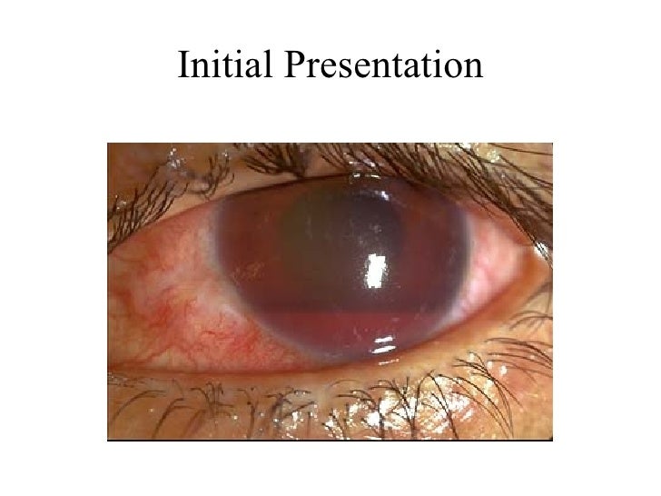 Traumatic Hyphema