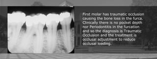 Traumatic occlusion | PPT