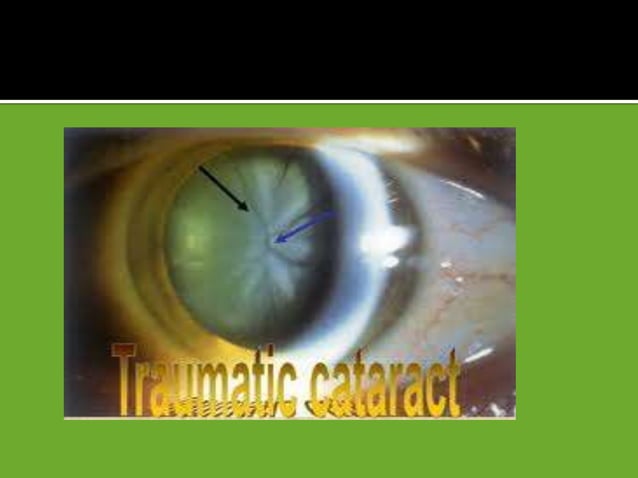 Traumatic and complicated cataract | PPT