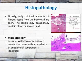 Traumatic bone cyst | PPTX