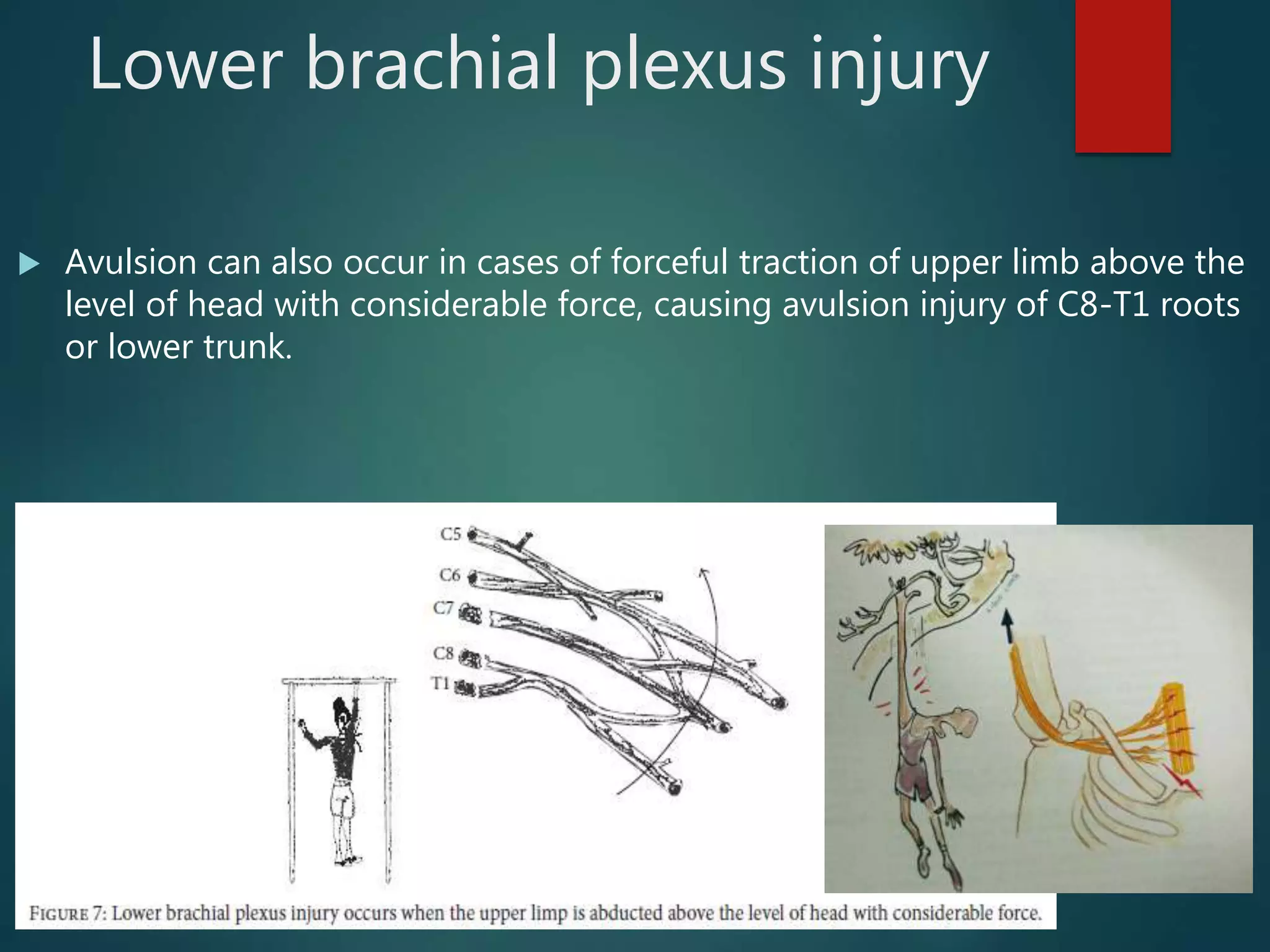 Traumatic brachial plexus injury | PPTX | Death, Injury, or Military ...