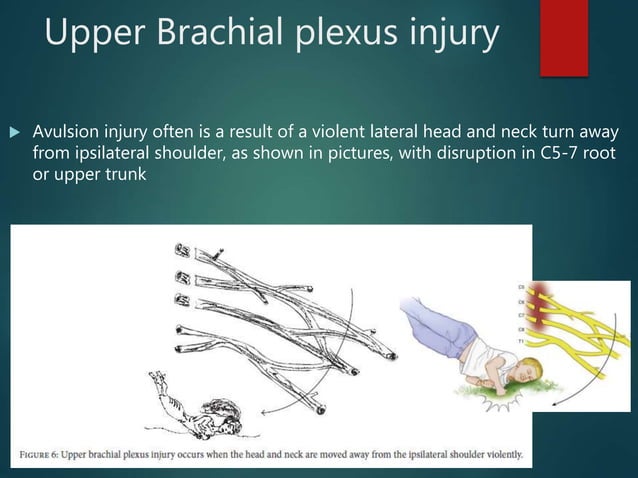 Traumatic brachial plexus injury | PPTX | Death, Injury, or Military Conflict | Sensitive Topics