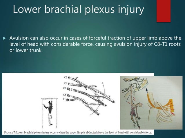 Traumatic brachial plexus injury | PPTX | Death, Injury, or Military Conflict | Sensitive Topics