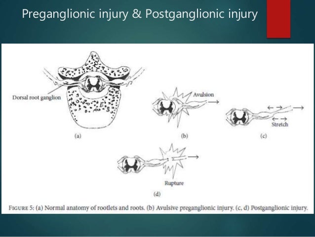 Traumatic brachial plexus injury