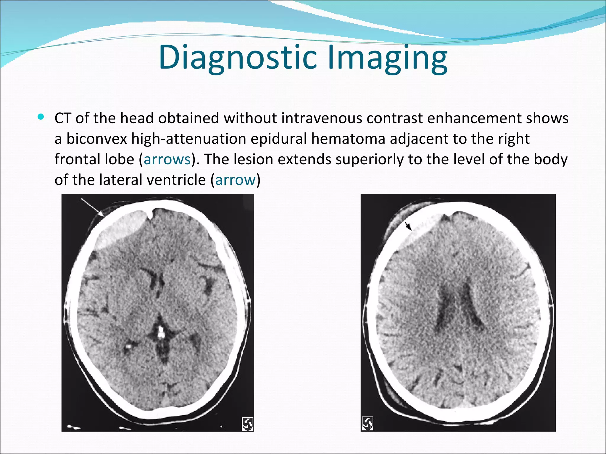 Traumatic brain injury | PPT