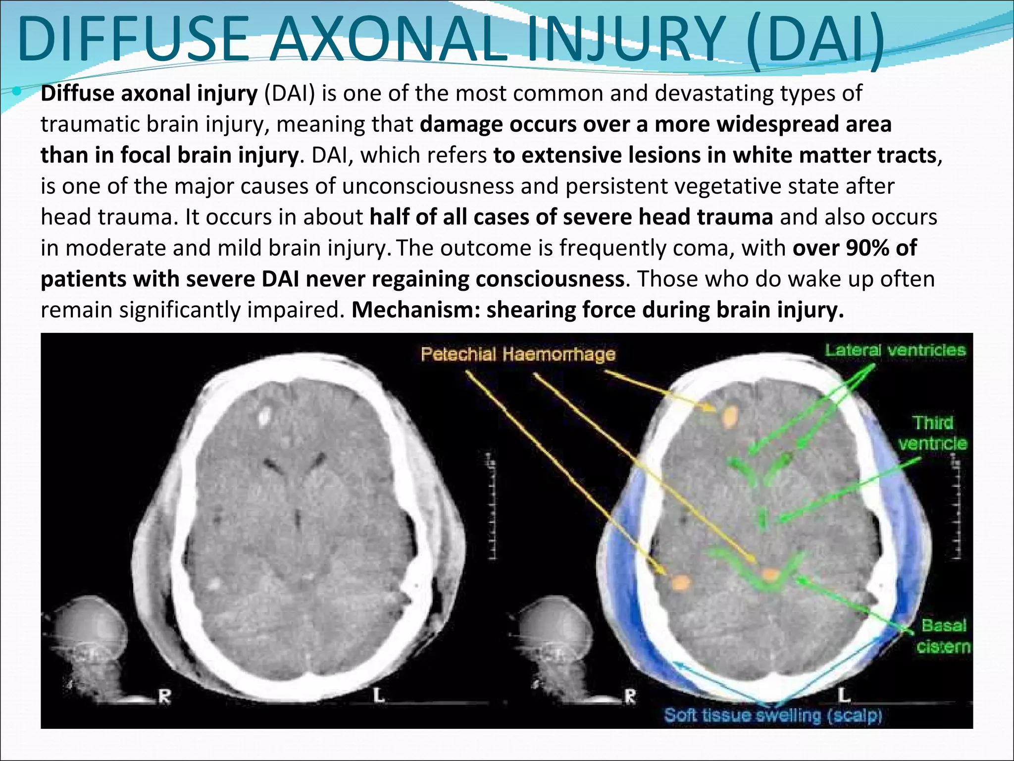 Traumatic brain injury | PPT