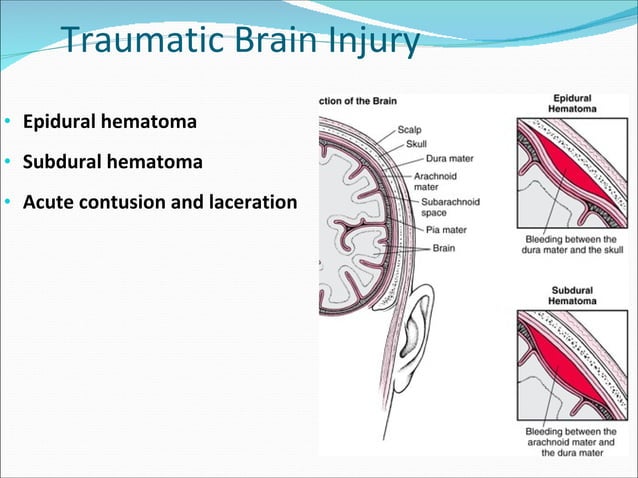 Traumatic brain injury | PPT