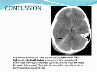 Traumatic brain injury | PPT