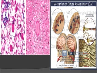 Diffuse Axonal Injury Histology