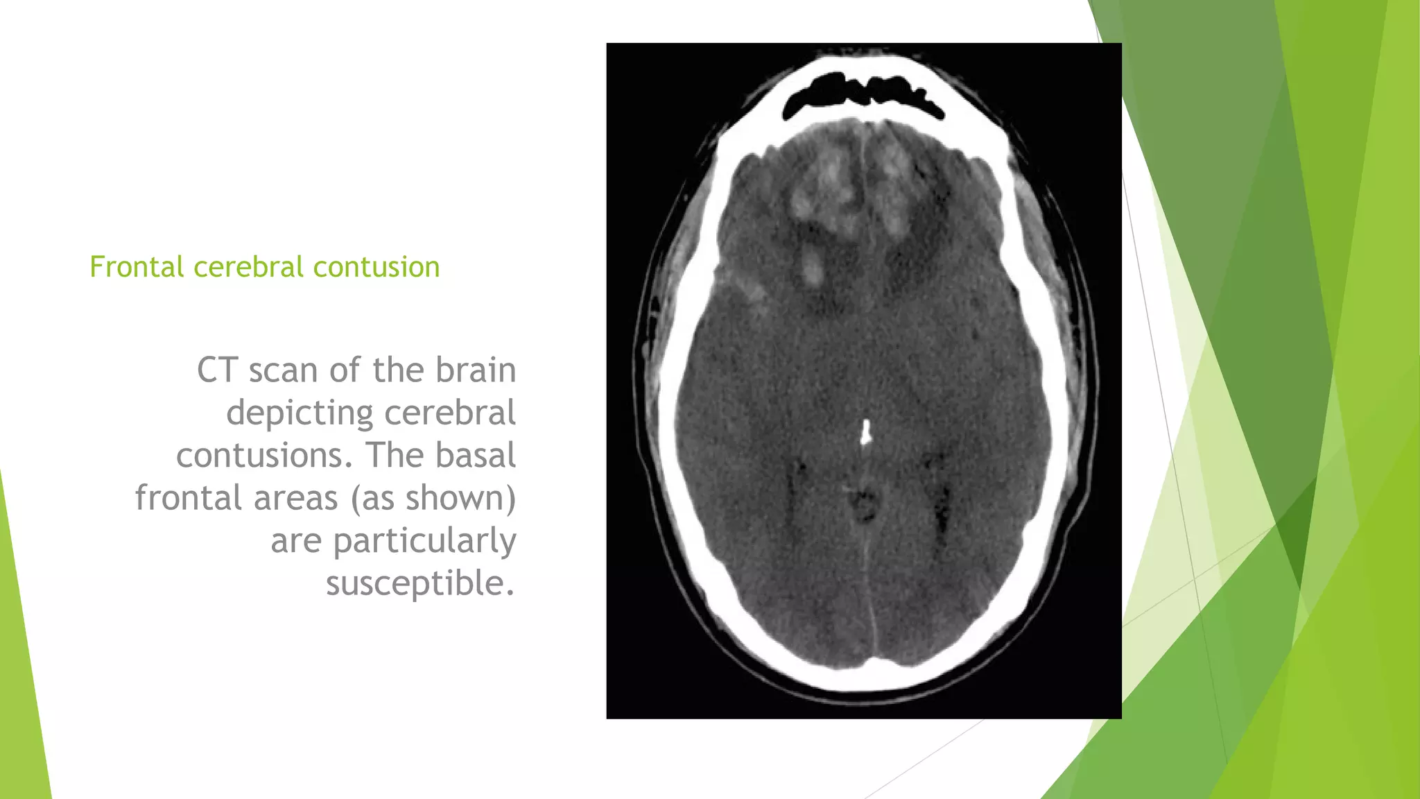 Traumatic brain injury | PPT