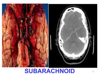 Traumatic brain injury | PPTX