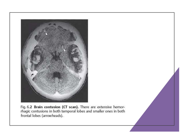 TRAUMATIC BRAIN INJURY | PPTX
