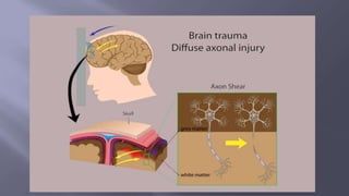 Traumatic brain injury | PPT