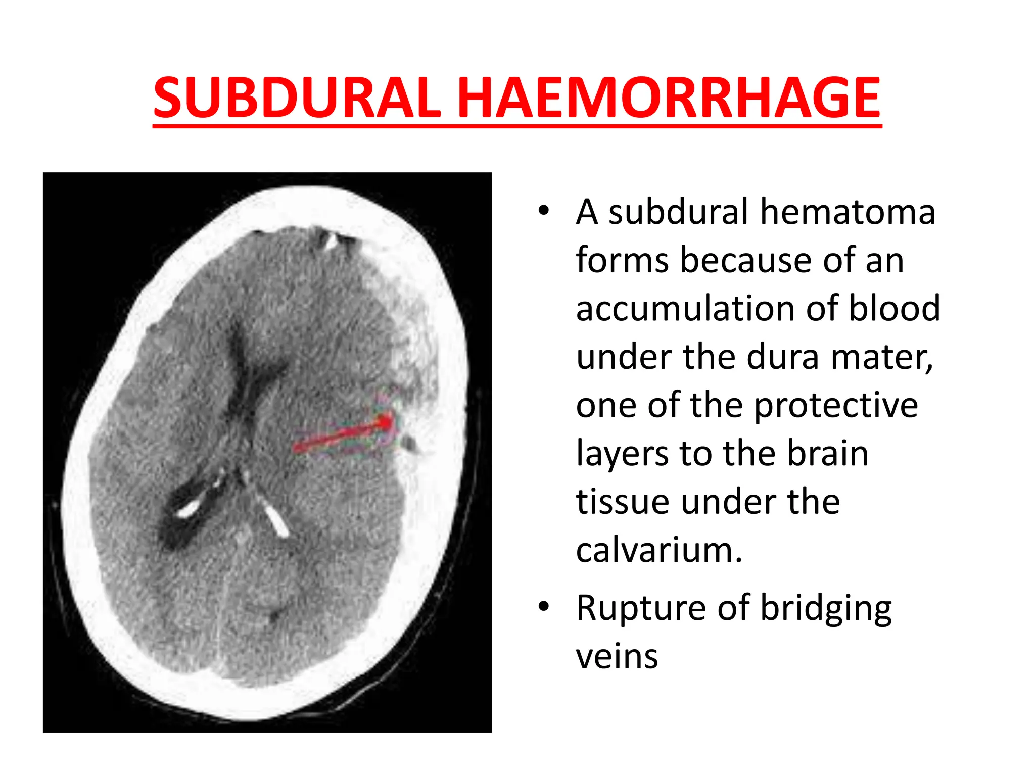 TRAUMATIC BRAIN INJURY and anesthetic management.pptx