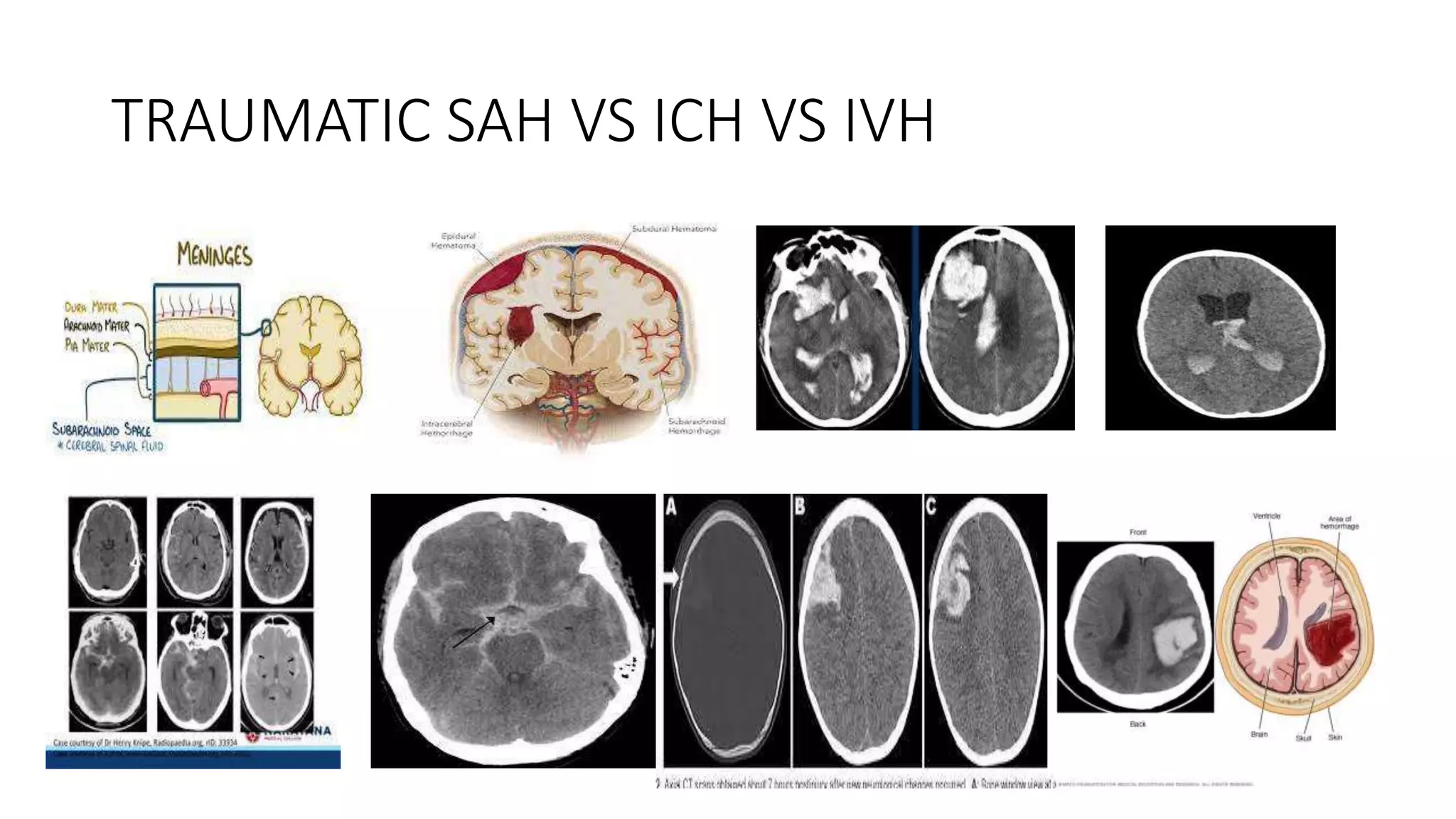 TRAUMATIC BRAIN INJURY - Copy.pptx