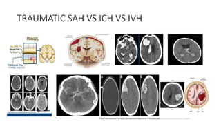 TRAUMATIC BRAIN INJURY - Copy.pptx