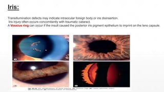 Traumatic Cataract.pptx