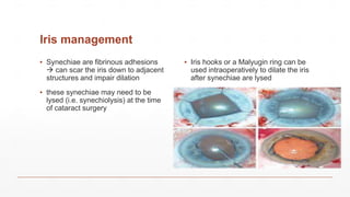 Traumatic Cataract.pptx