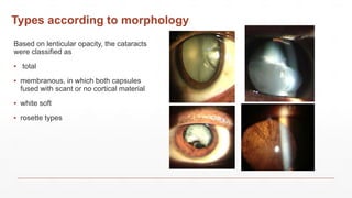 Traumatic Cataract.pptx