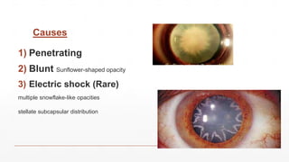 Traumatic Cataract