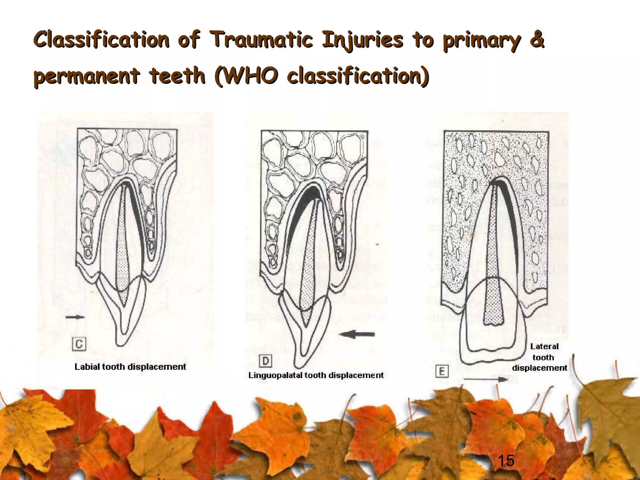 Classification of traumatic Injuries to anterior teeth of children | PPT