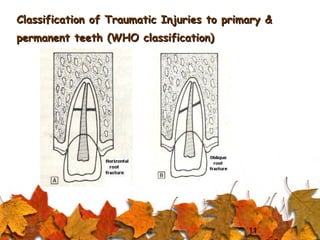 Classification of traumatic Injuries to anterior teeth of children | PPT