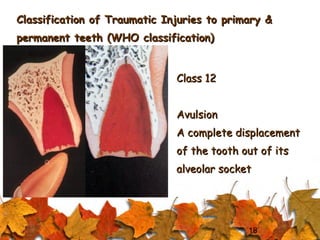 Classification of traumatic Injuries to anterior teeth of children | PPT