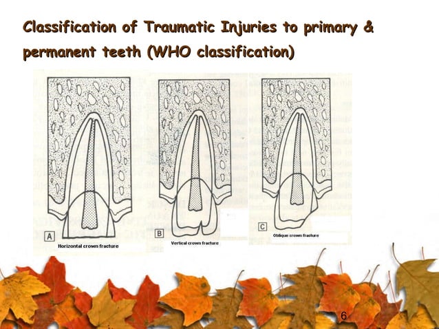 Classification of traumatic Injuries to anterior teeth of children | PPT
