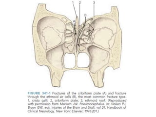 Traumatic csf fistula.pptx