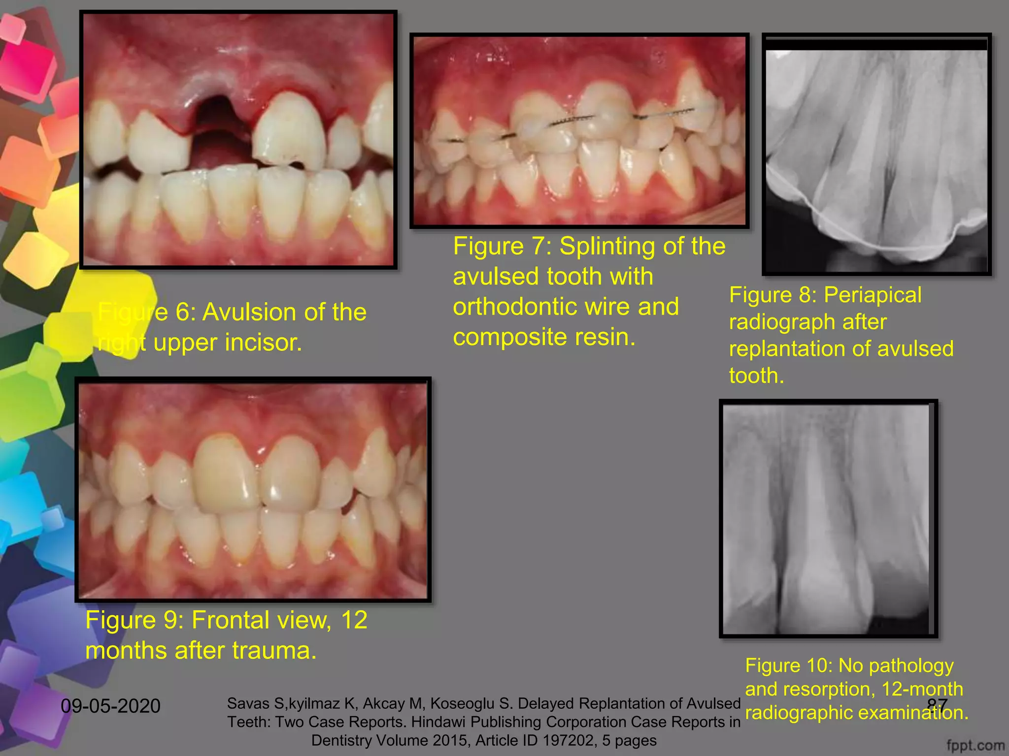 Traumatic Dental Injuries to Permanent Teeth | PPT