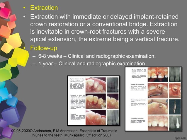 Traumatic Dental Injuries to Permanent Teeth | PPT | Dental Health ...