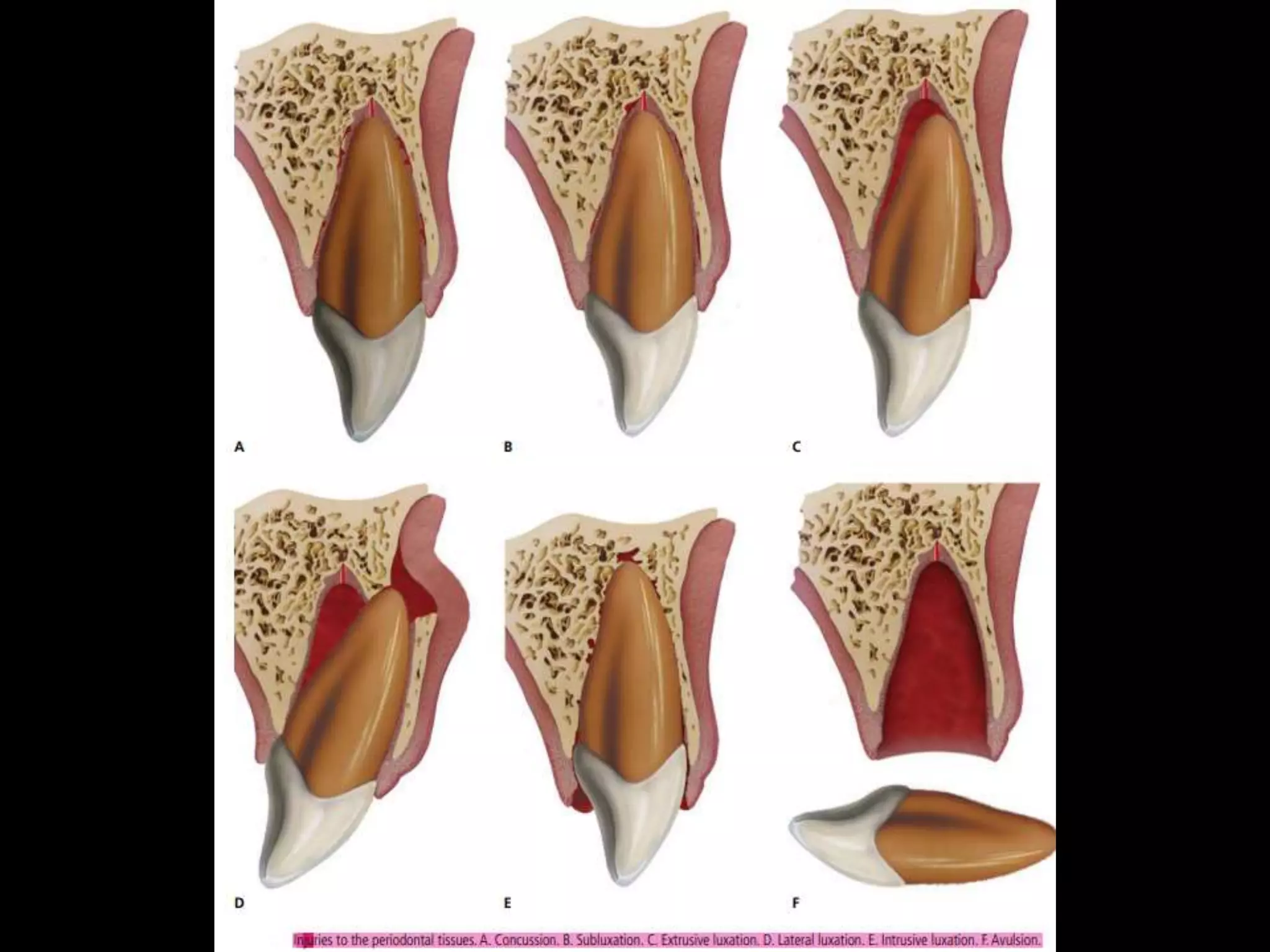 TRAUMATIC DENTAL INJURIES IN CHILDREN.pptx