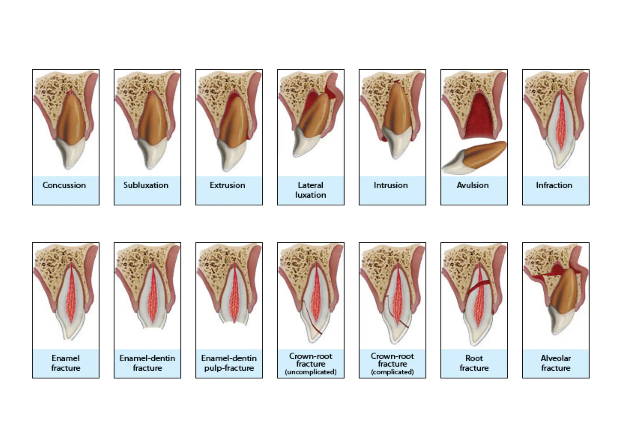 Traumatic Dental injuries in endodontology .pdf