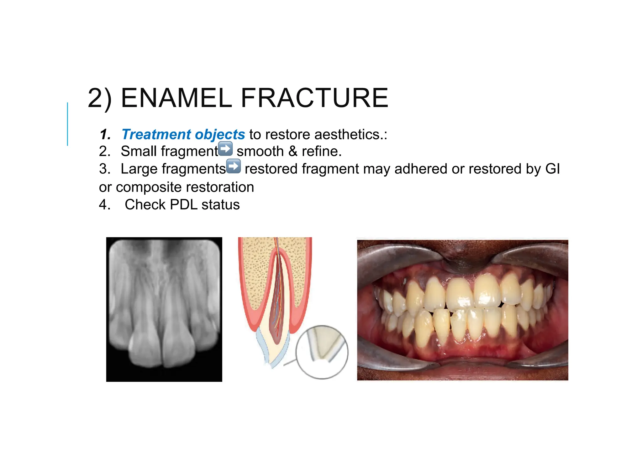 Traumatic Dental injuries in endodontology .pdf