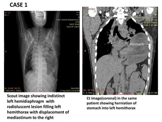 TRAUMATIC DIAPHRAGMATIC INJURY.pptx