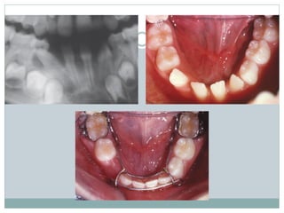 Traumatic displacement of teeth.pdf
