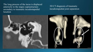 Traumatic ear | PPTX