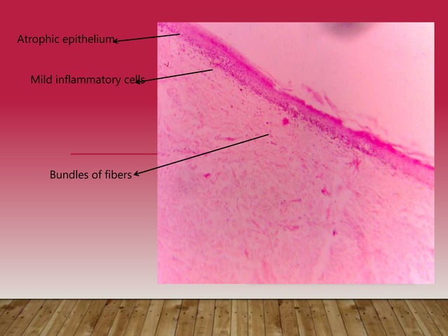 Traumatic fibroma made easy | PPTX | Ear, Nose and Throat Conditions ...