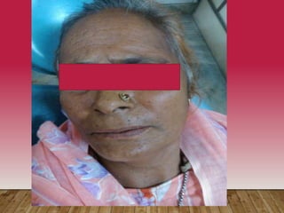 Traumatic fibroma made easy | PPTX