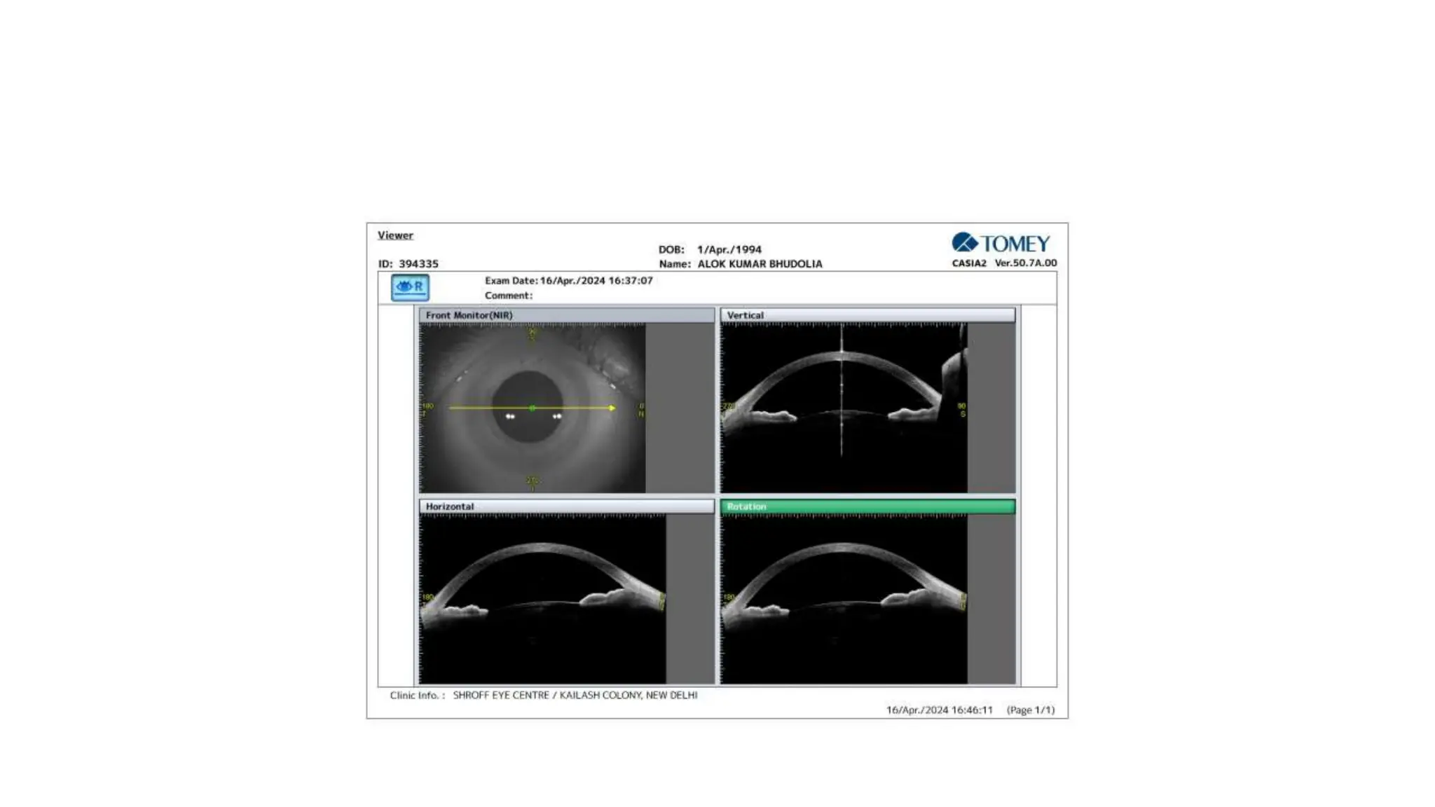 Traumatic glaucoma +uveitis PRESENTATION | PPTX