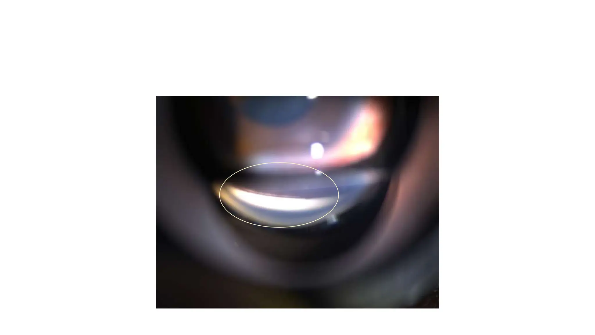 Traumatic glaucoma +uveitis PRESENTATION | PPTX