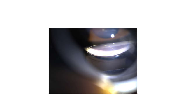 Traumatic glaucoma +uveitis PRESENTATION | PPTX