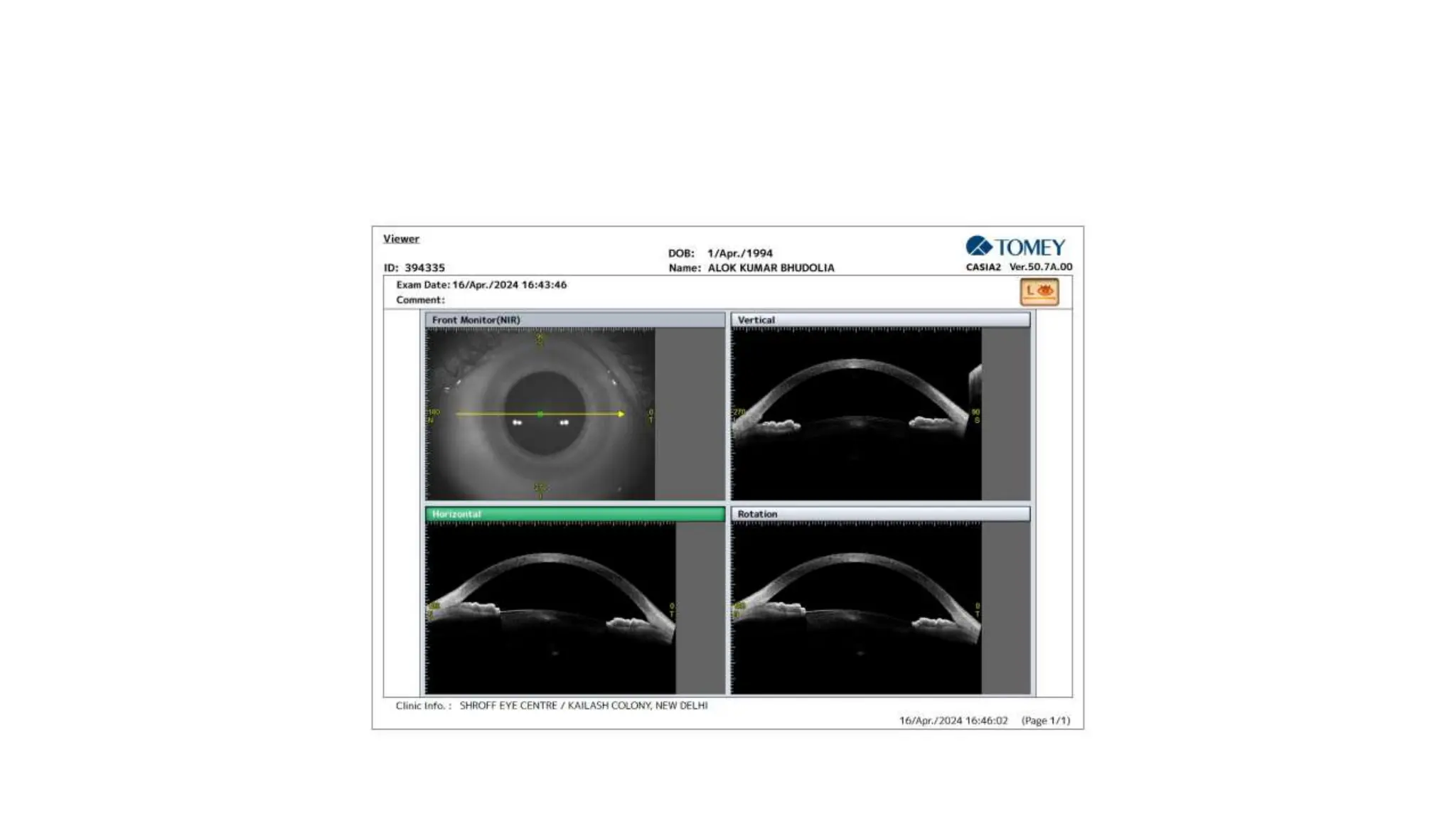 Traumatic glaucoma uveitis CASE PRESENTATION | PPTX