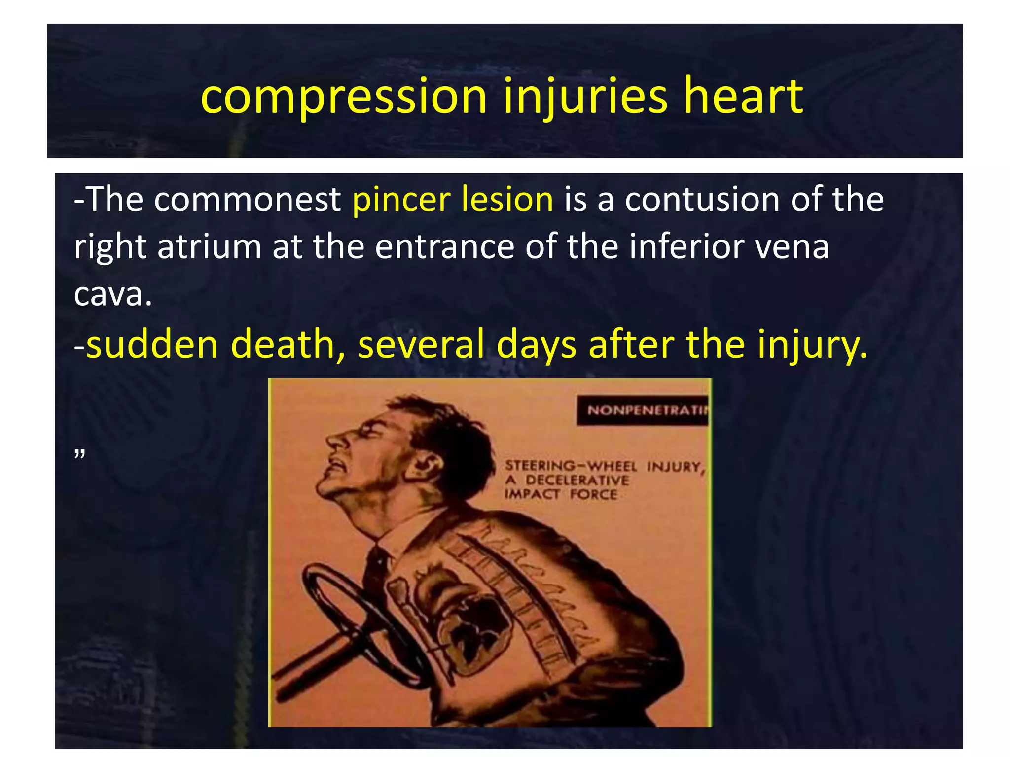 Traumatic heart injuries a brief | PPTX | Death, Injury, or Military ...