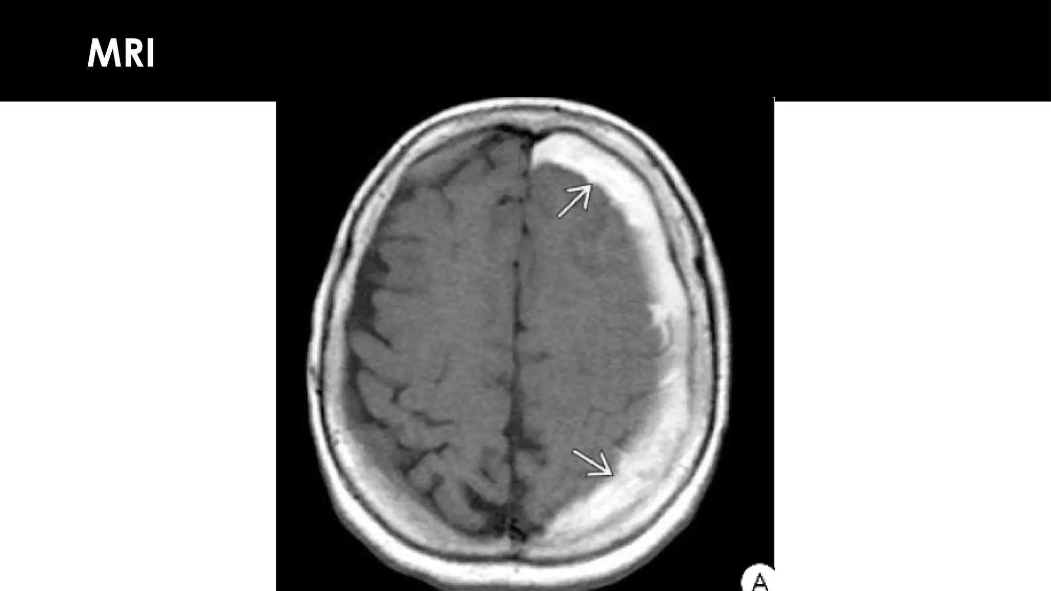 Traumatic Intracranial Hemorrhage: Radiology.pptx