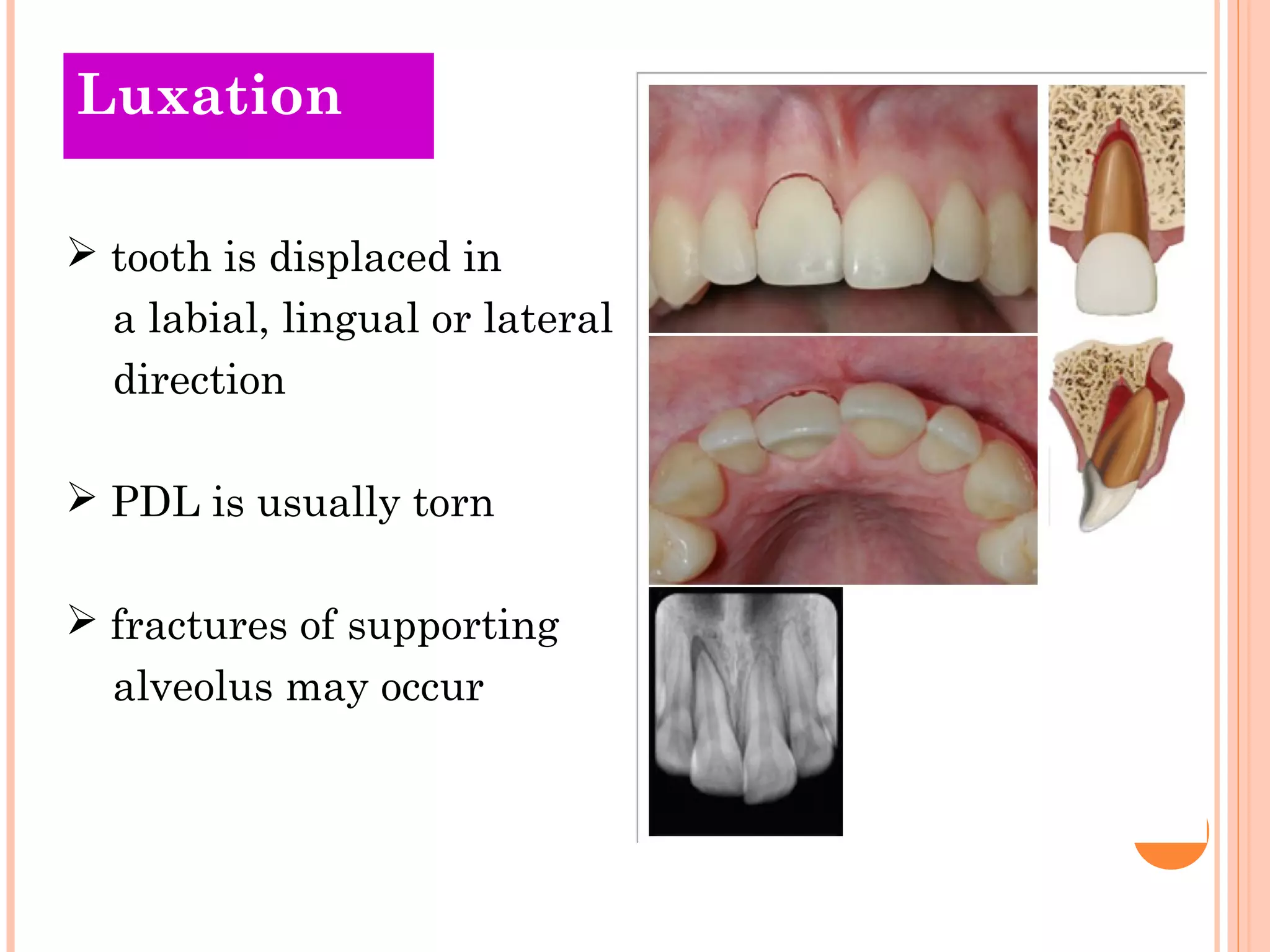 Traumatic injuries of teeth | PPT