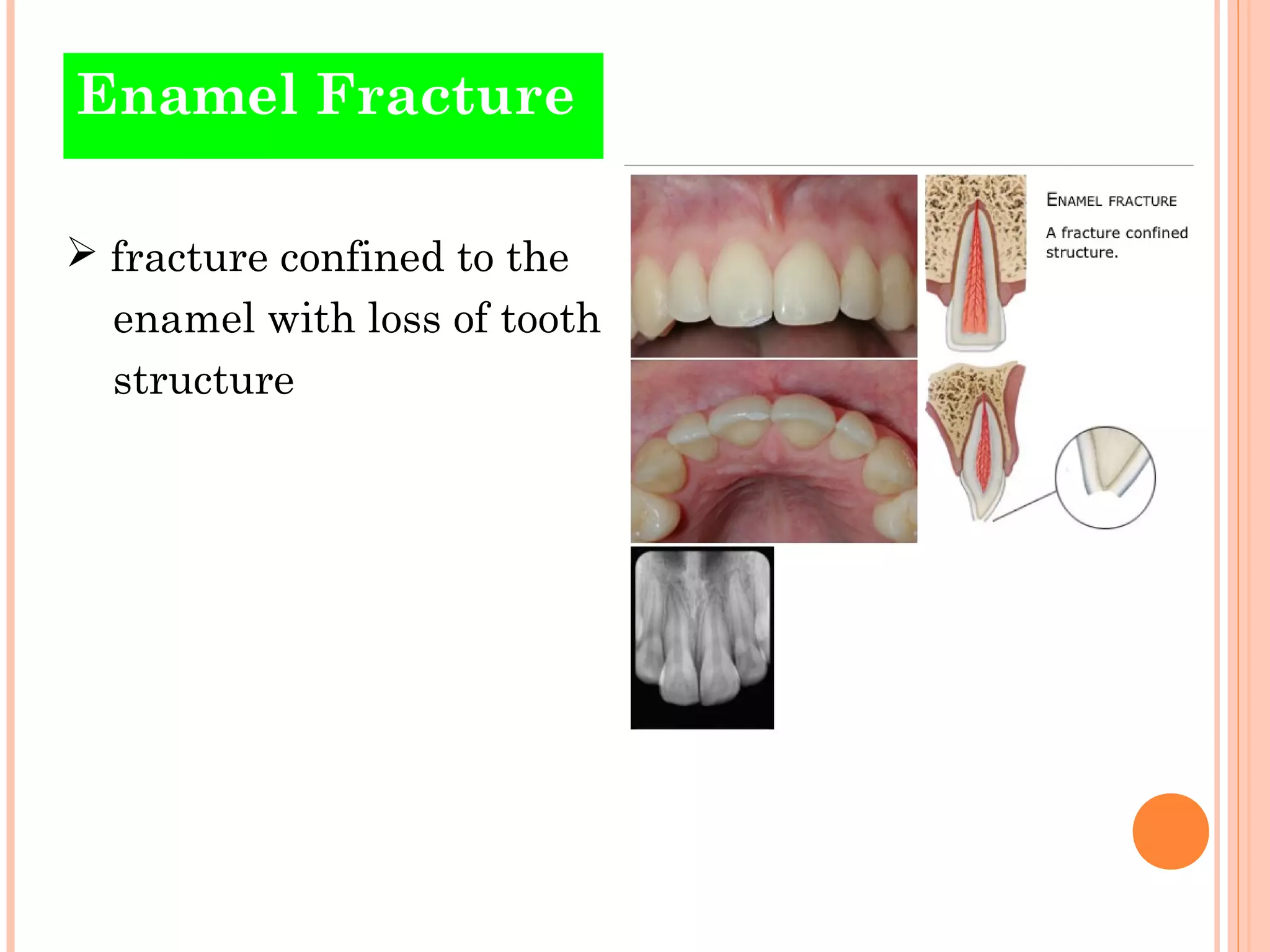 Traumatic injuries of teeth | PPT